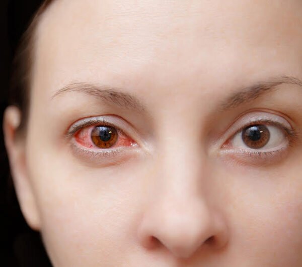 Treat Pink Eye Quickly with Expert Care at Medicross Clinic