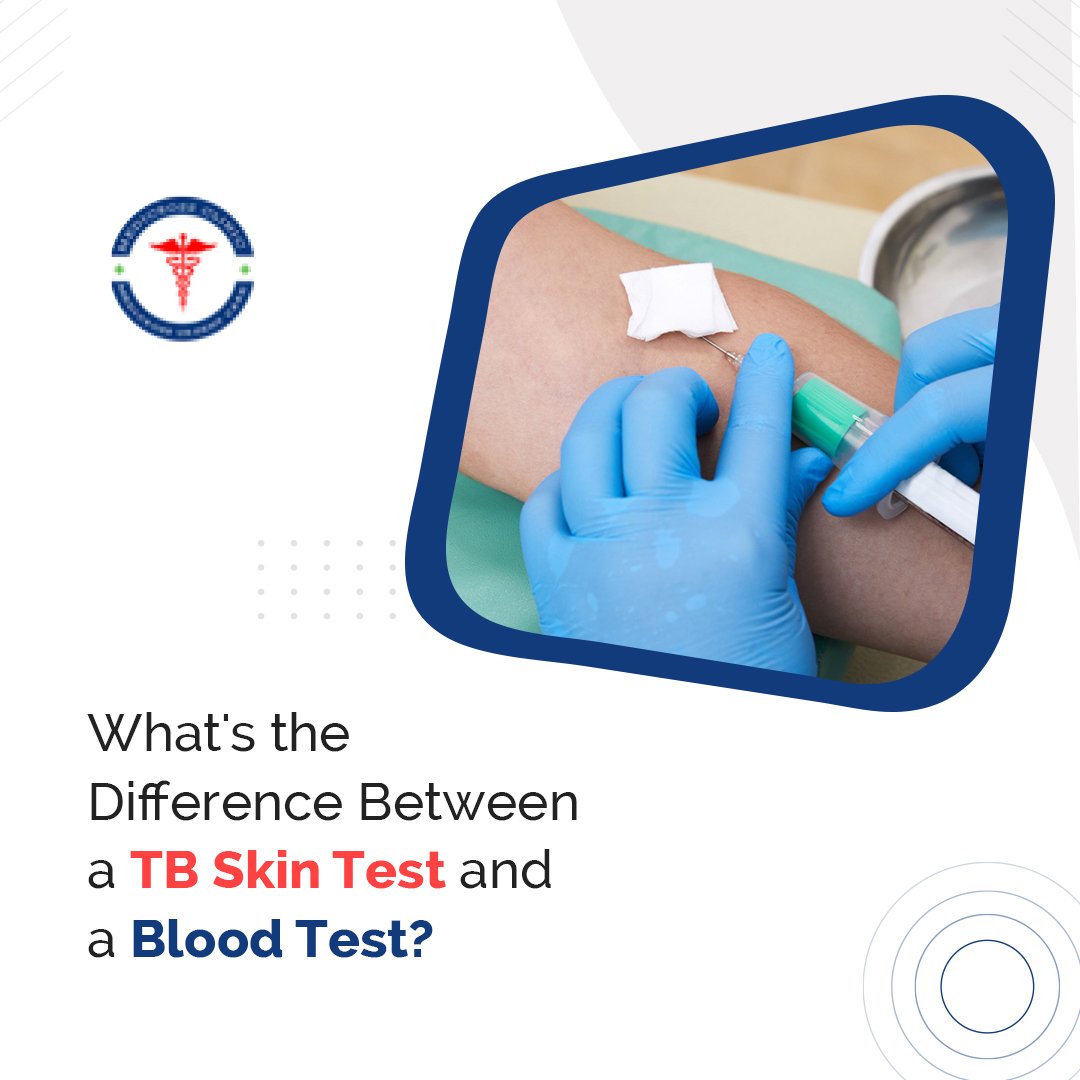 What's the Difference between a TB Skin Test and a Blood Test?